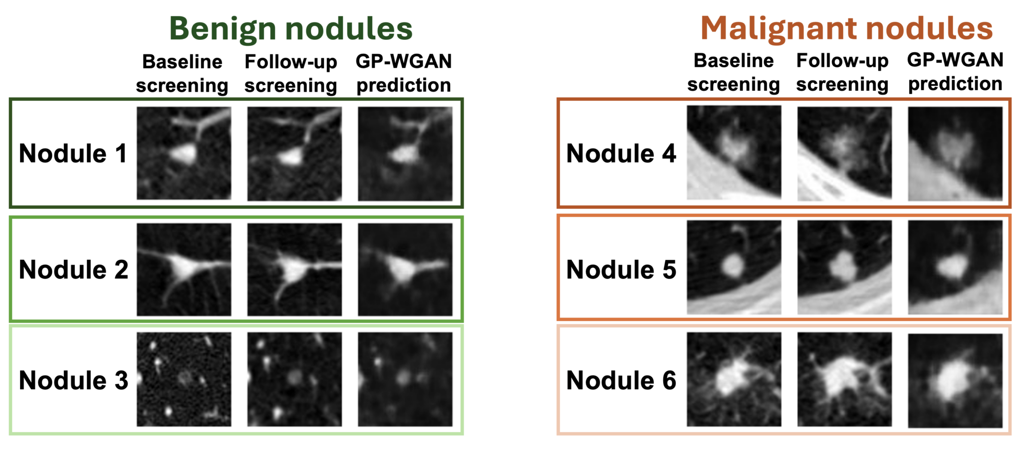 Leveraging artificial intelligence for early detection of lung cancer